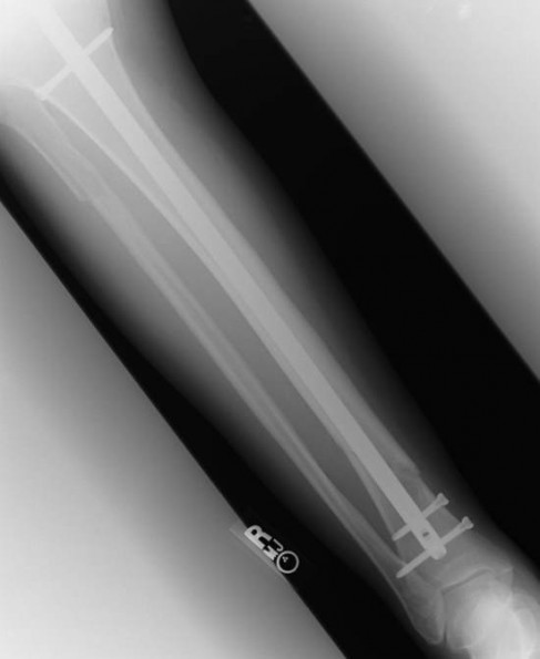 Common injuries sustained in motorbike crashes